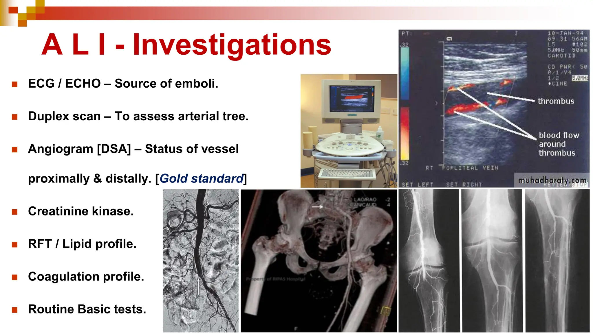Acute Arerial Diseases - Acute Limb Ischemia | PDF
