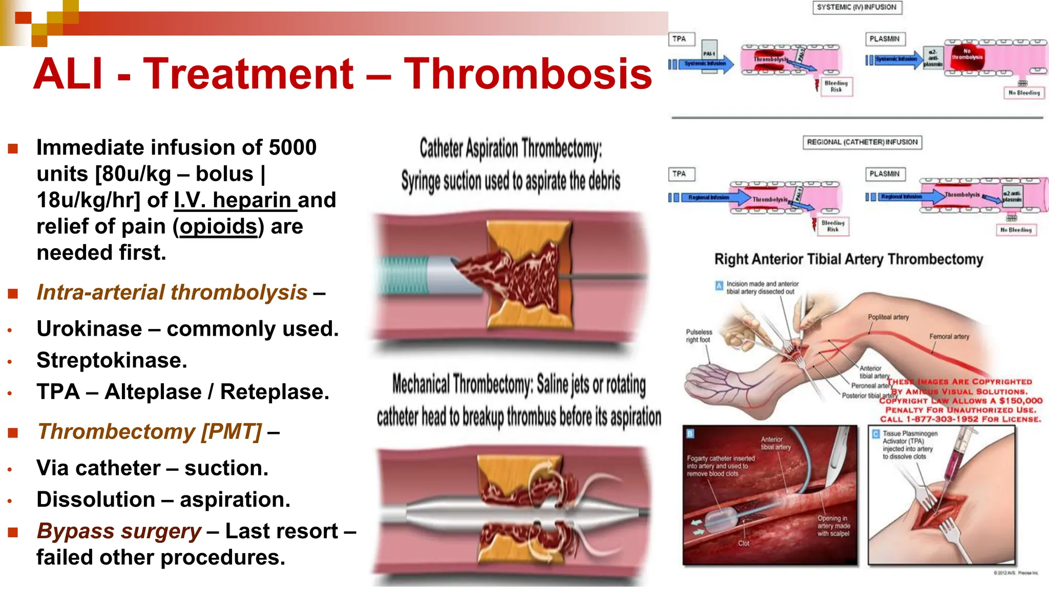 Acute Arerial Diseases - Acute Limb Ischemia | PDF