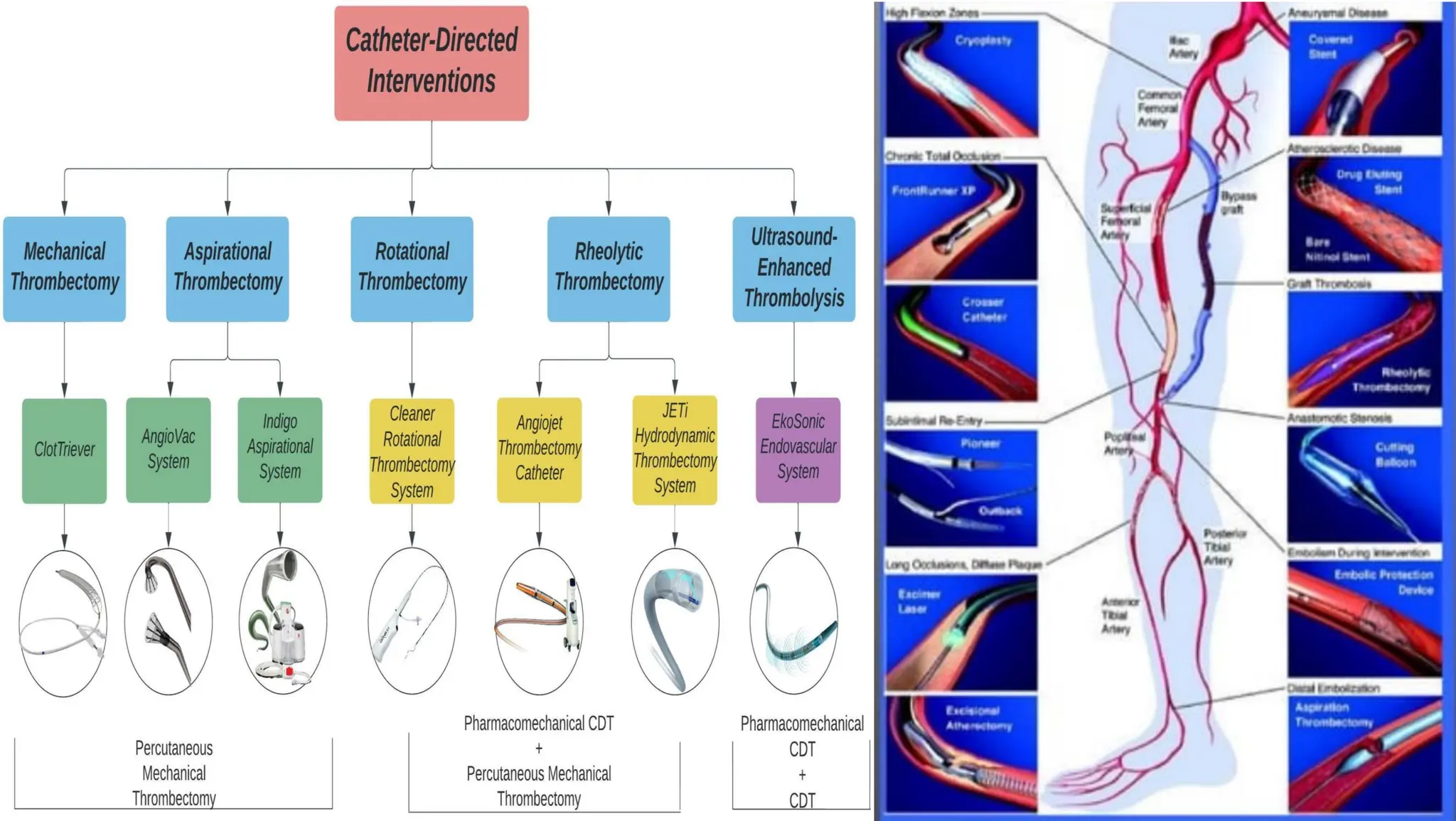 Acute Arerial Diseases - Acute Limb Ischemia | PDF