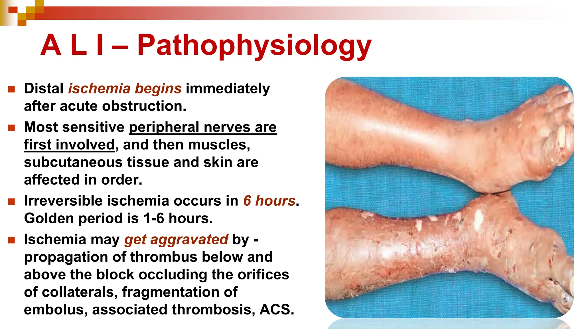 Acute Arerial Diseases - Acute Limb Ischemia | PDF