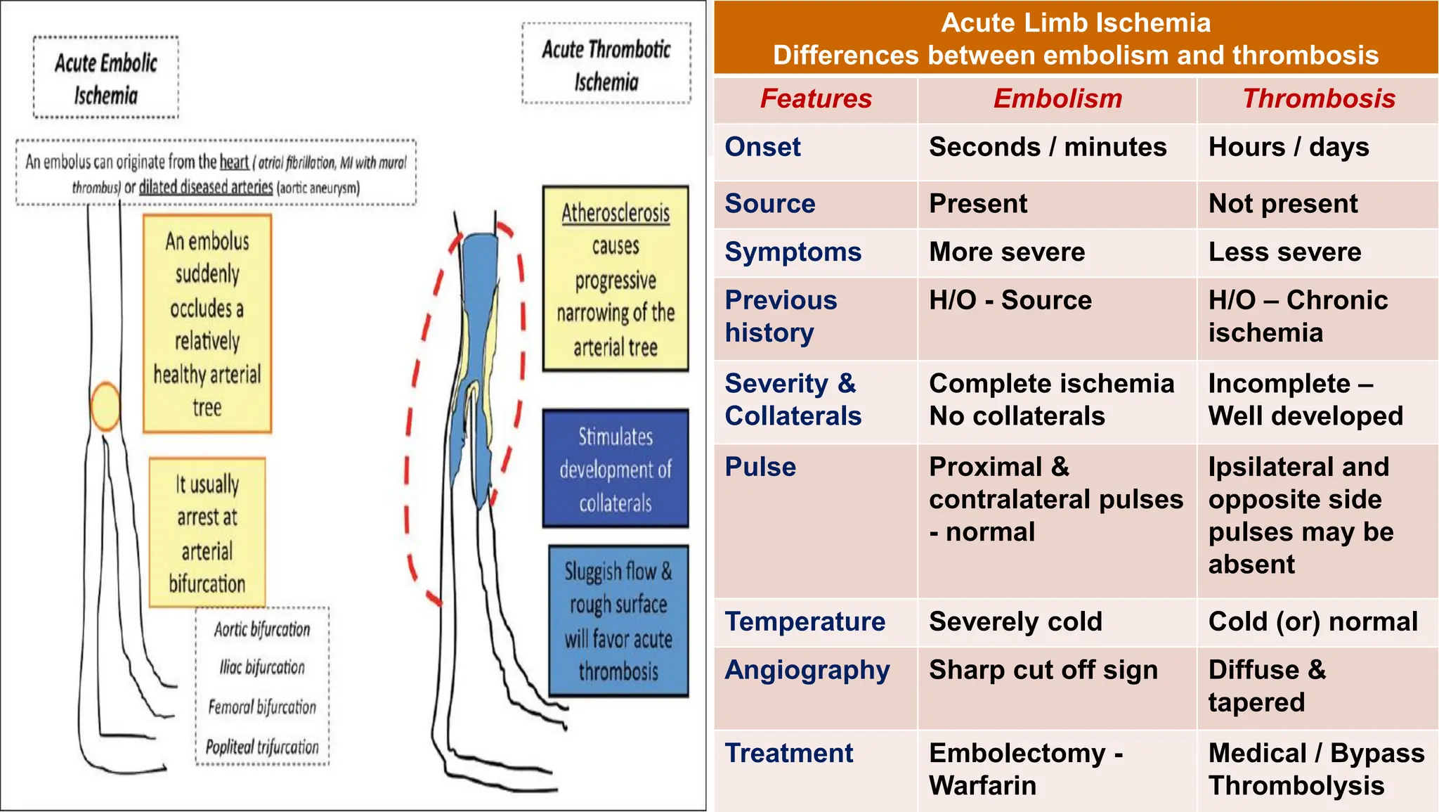 Acute Arerial Diseases - Acute Limb Ischemia | PDF