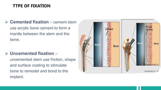 ORTHOPEDIC (HIP BONE) | PPT