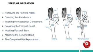 ORTHOPEDIC (HIP BONE) | PPT