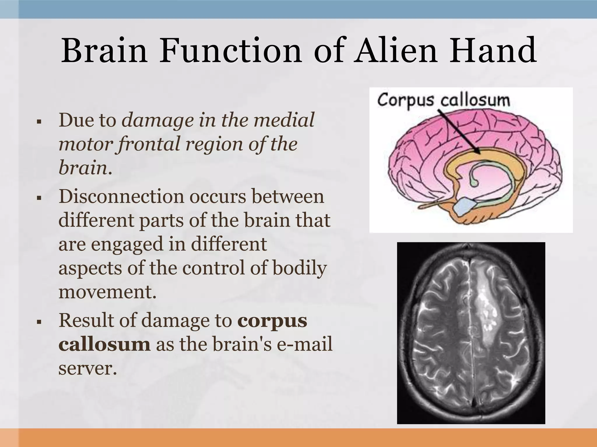 Alien hand syndrome | PPTX