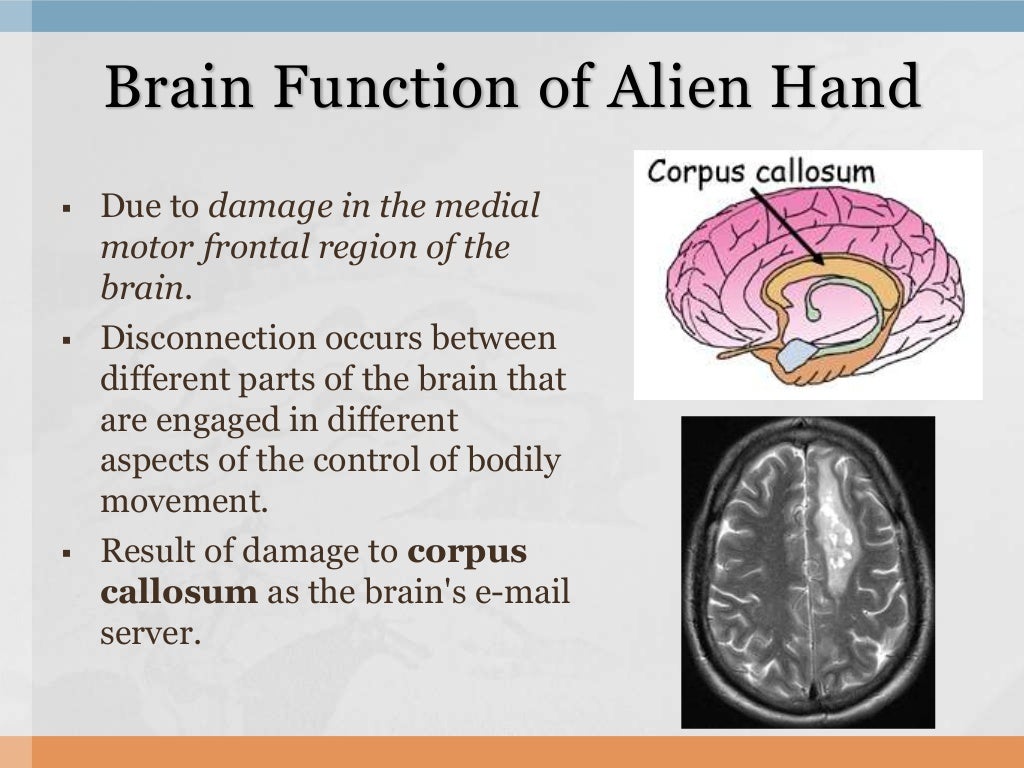 Alien hand syndrome