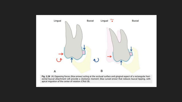 Aligner biomech-1.pptx biomechanics, orthodontics | PPTX | Dental ...