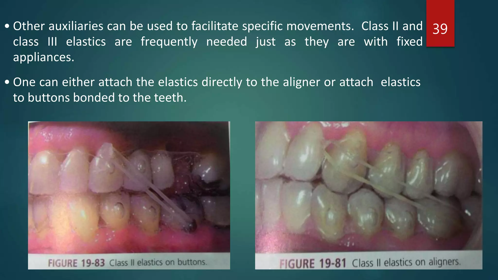 Aligners | PPTX