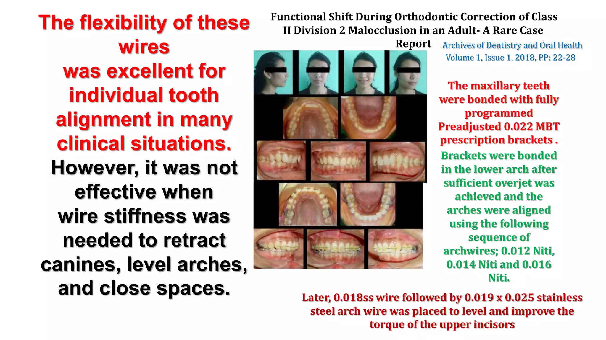 Orthodontic alignment phase of pre-adjusted fixed appliance PART 1 | PPTX