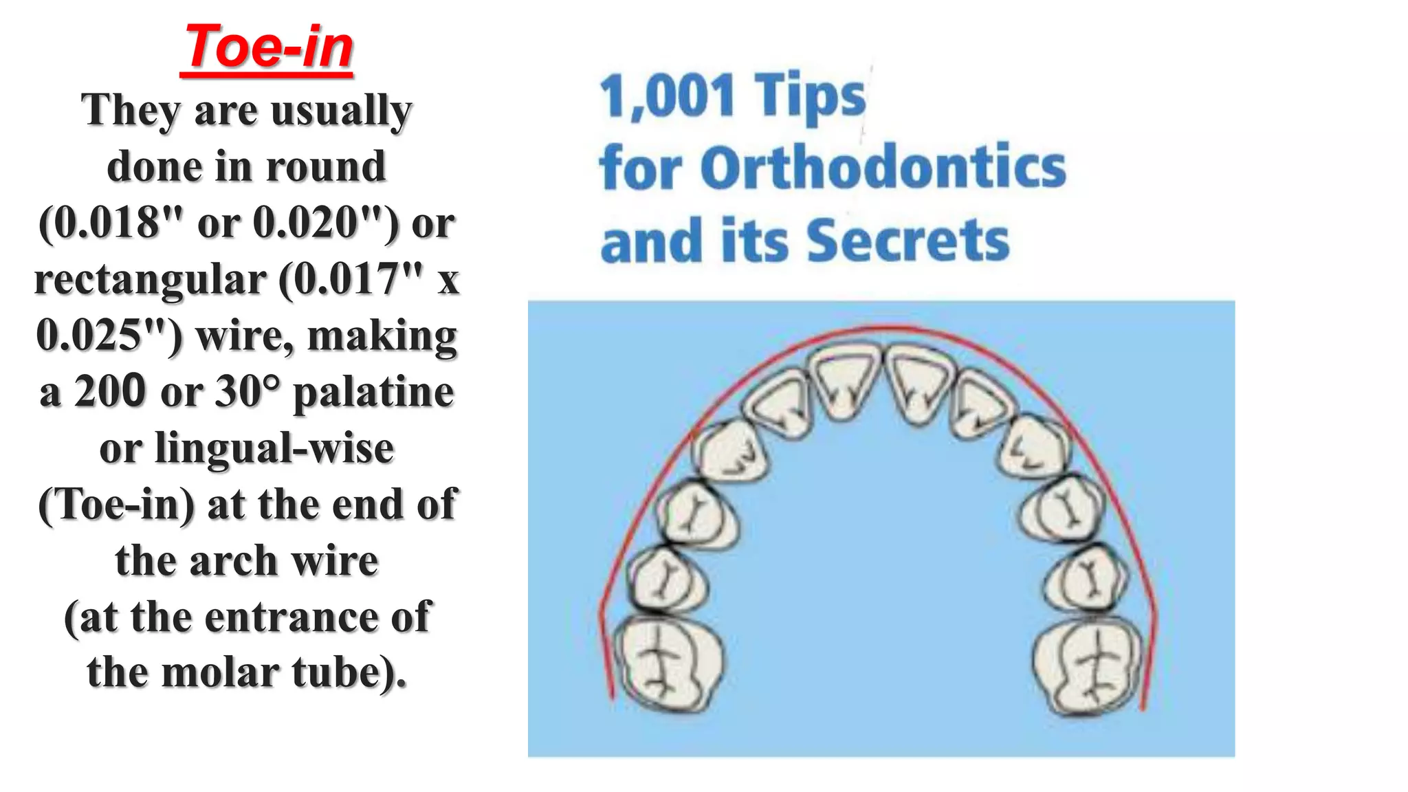 Orthodontic alignment phase of pre-adjusted fixed appliance PART 1 | PPTX