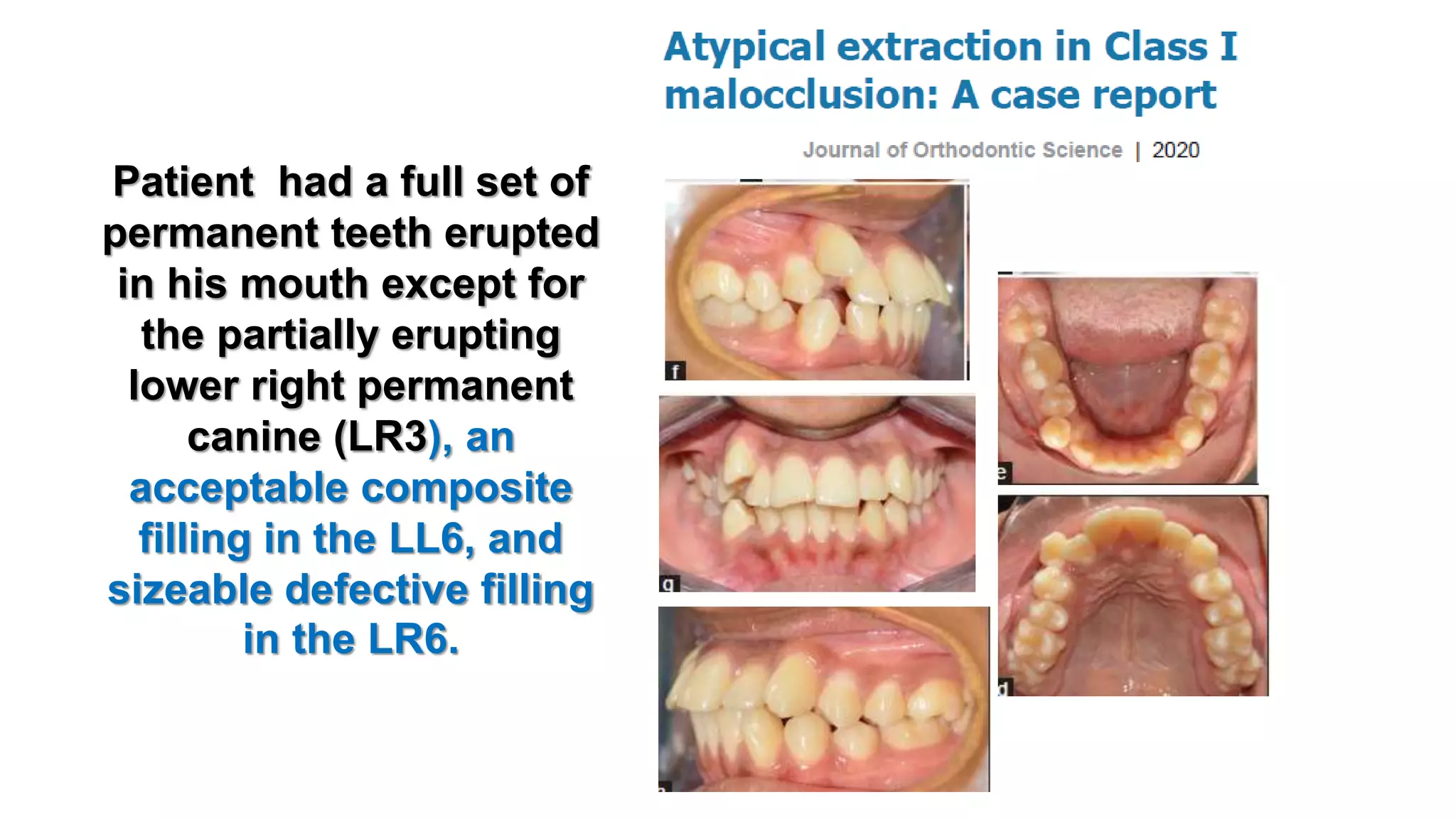 Orthodontic alignment phase of pre-adjusted fixed appliance PART 1 | PPTX