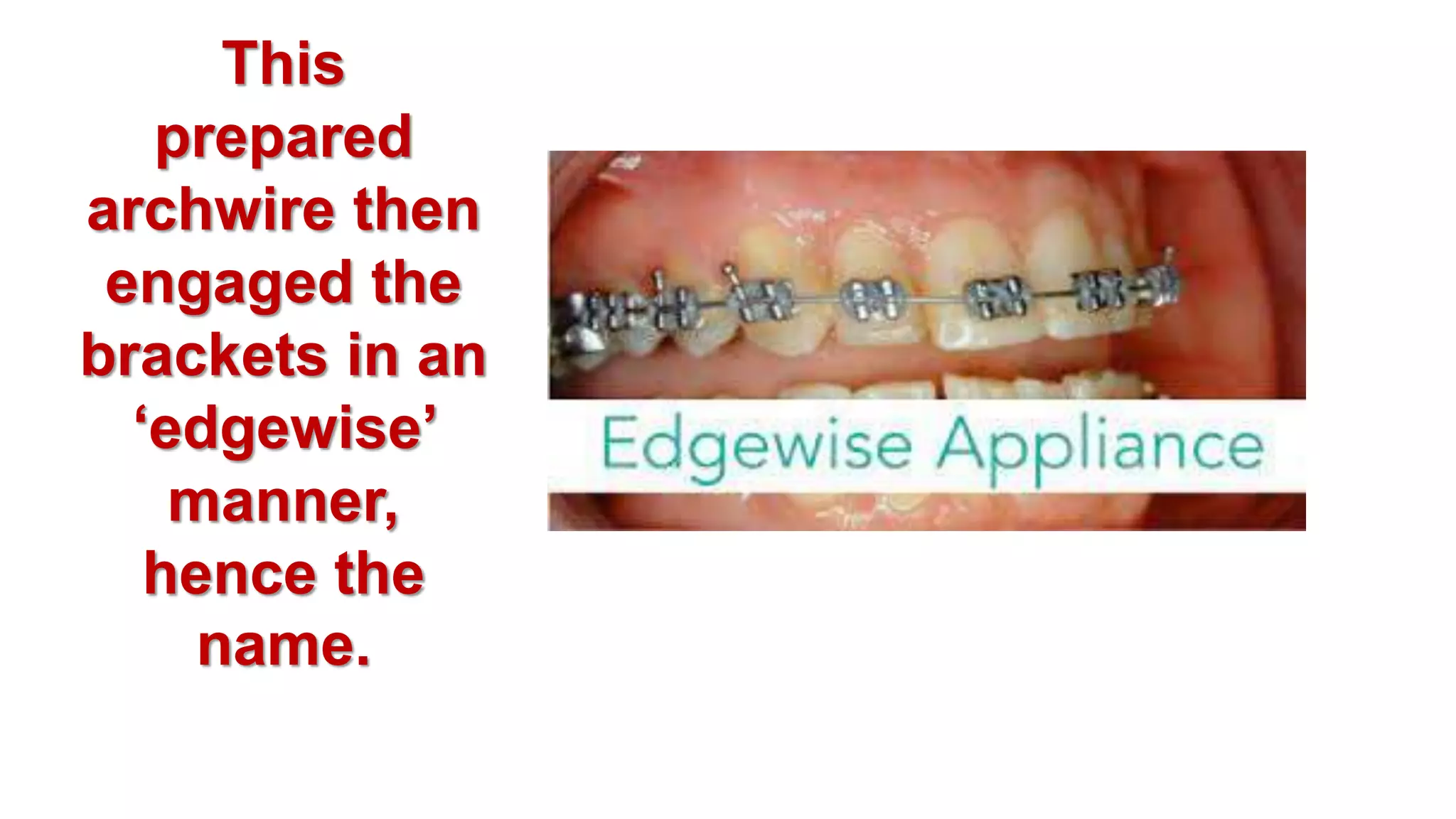 Orthodontic alignment phase of pre-adjusted fixed appliance PART 1 | PPTX