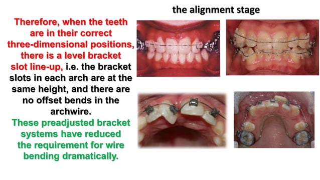 Orthodontic alignment phase of pre-adjusted fixed appliance PART 1 | PPTX