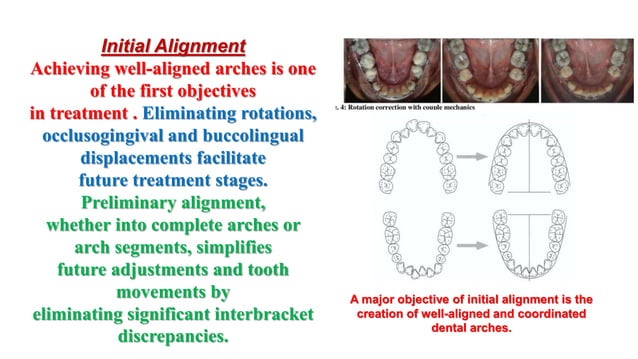 Orthodontic alignment phase of pre-adjusted fixed appliance PART 1 | PPTX