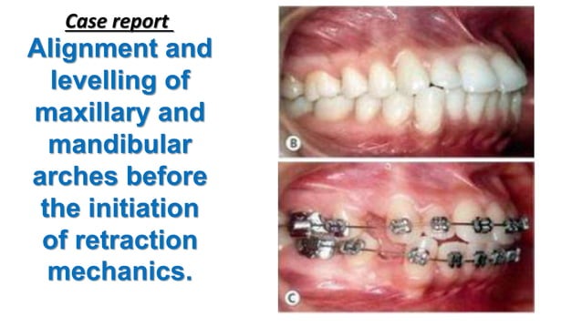 Orthodontic alignment phase of pre-adjusted fixed appliance part 2 ...
