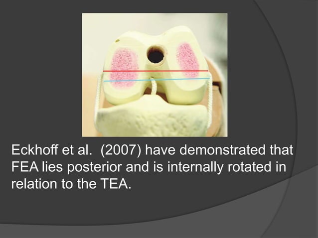 Alignment and fixation in total knee journal club.pptx