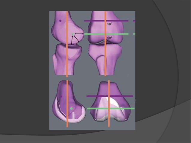 Alignment and fixation in total knee journal club.pptx