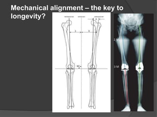 Alignment and fixation in total knee journal club.pptx