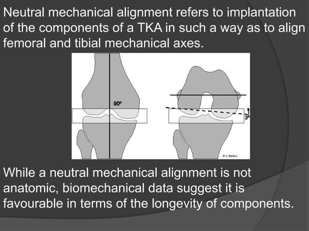 Alignment and fixation in total knee journal club.pptx