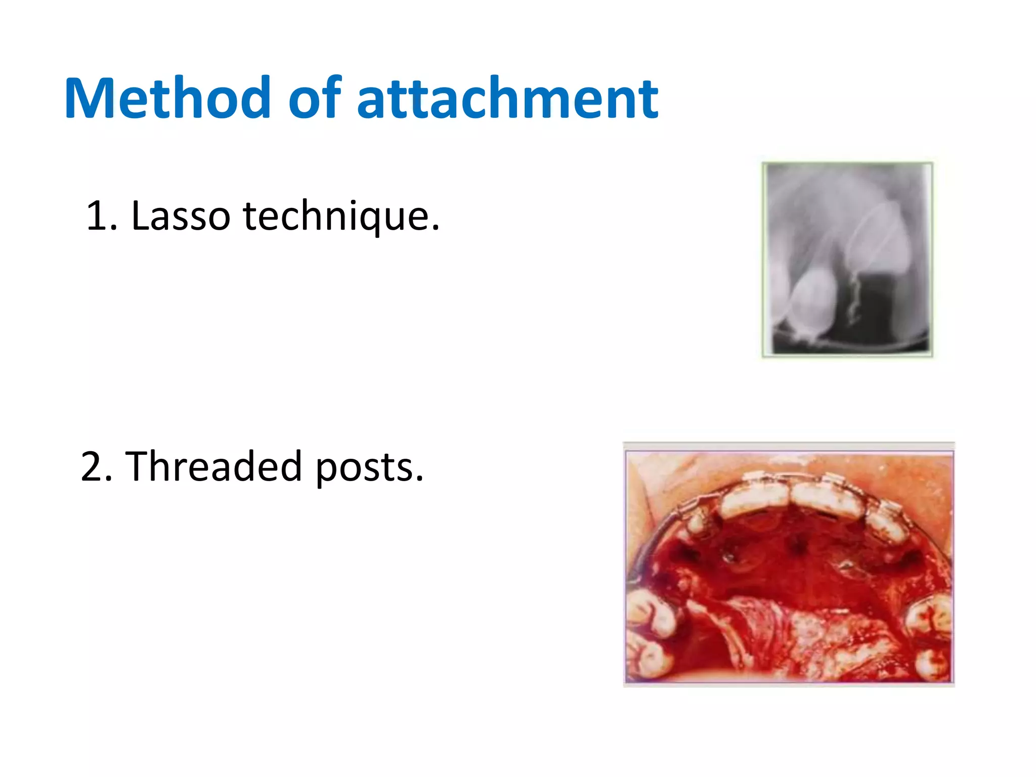 Alignment and leveling | PPTX