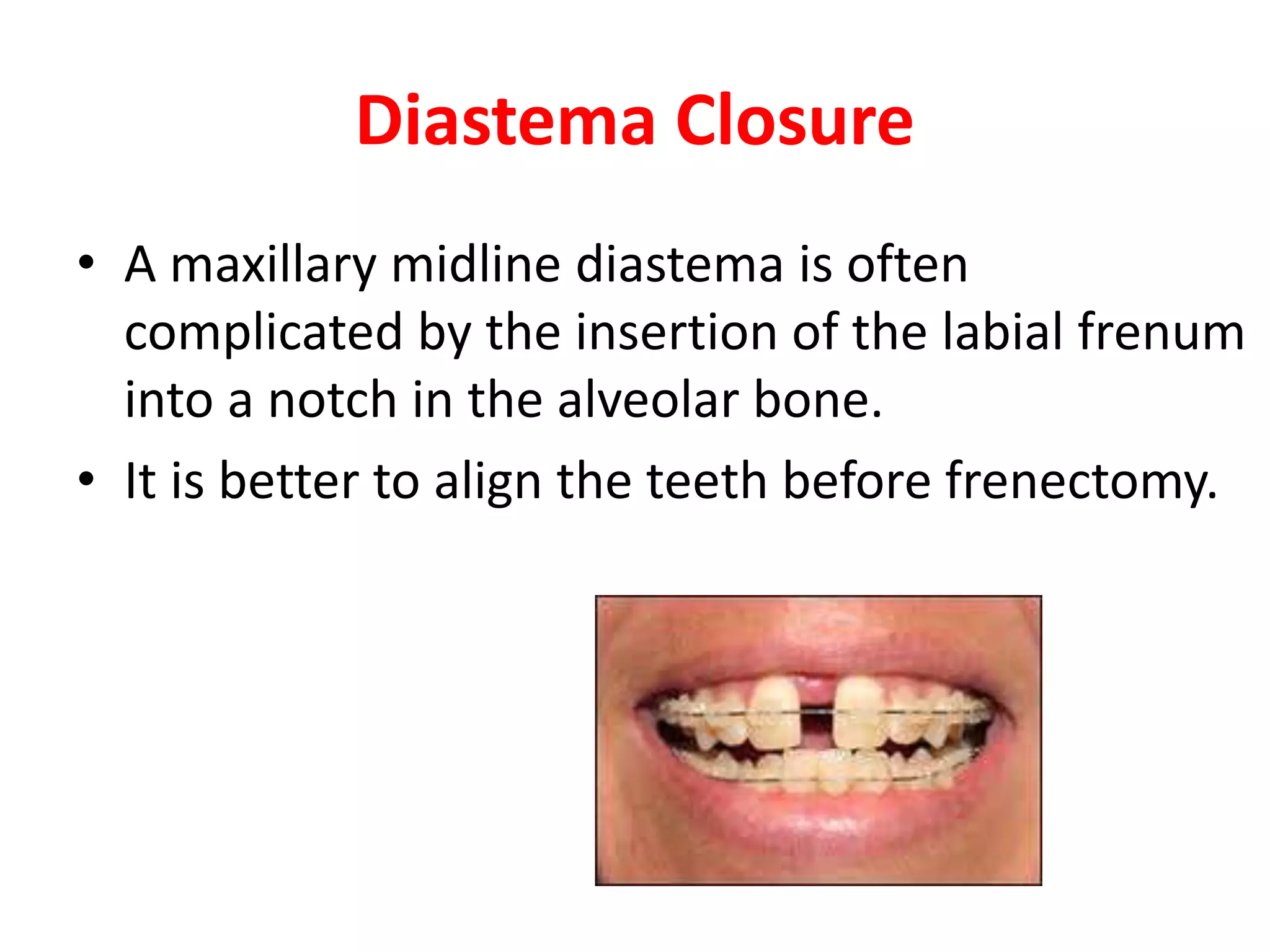Alignment and leveling | PPTX