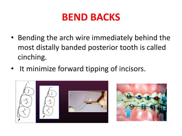 Alignment and leveling | PPTX | Dental Health | Diseases and Conditions