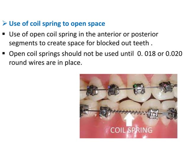 Alignment and leveling | PPTX | Dental Health | Diseases and Conditions