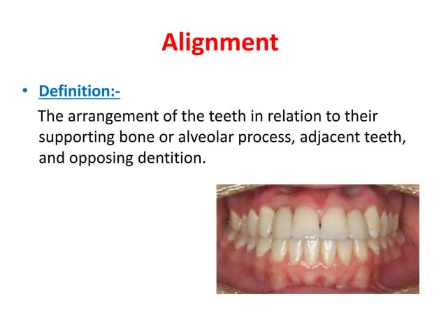 Alignment and leveling | PPTX | Dental Health | Diseases and Conditions