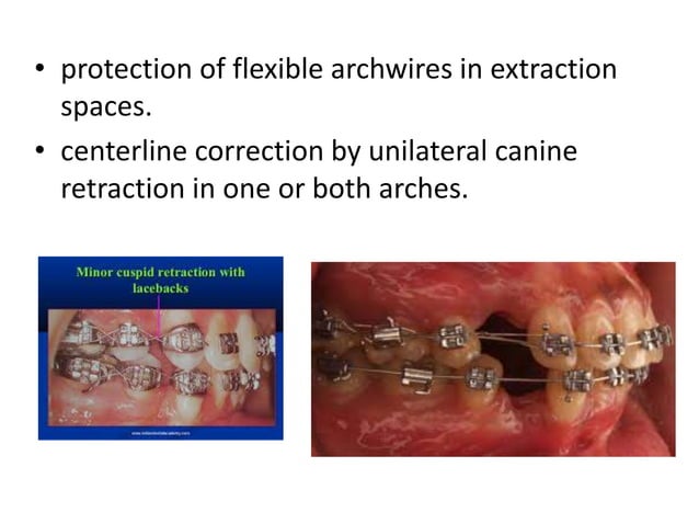 Alignment and leveling | PPTX | Dental Health | Diseases and Conditions