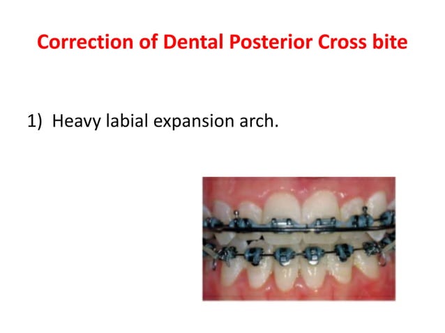 Alignment and leveling | PPTX | Dental Health | Diseases and Conditions