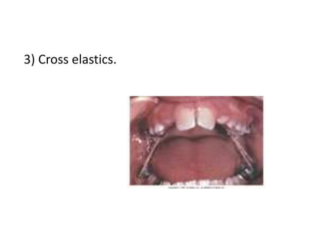 Alignment and leveling | PPTX | Dental Health | Diseases and Conditions