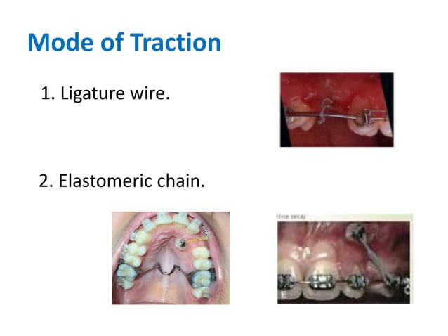 Alignment and leveling | PPTX | Dental Health | Diseases and Conditions