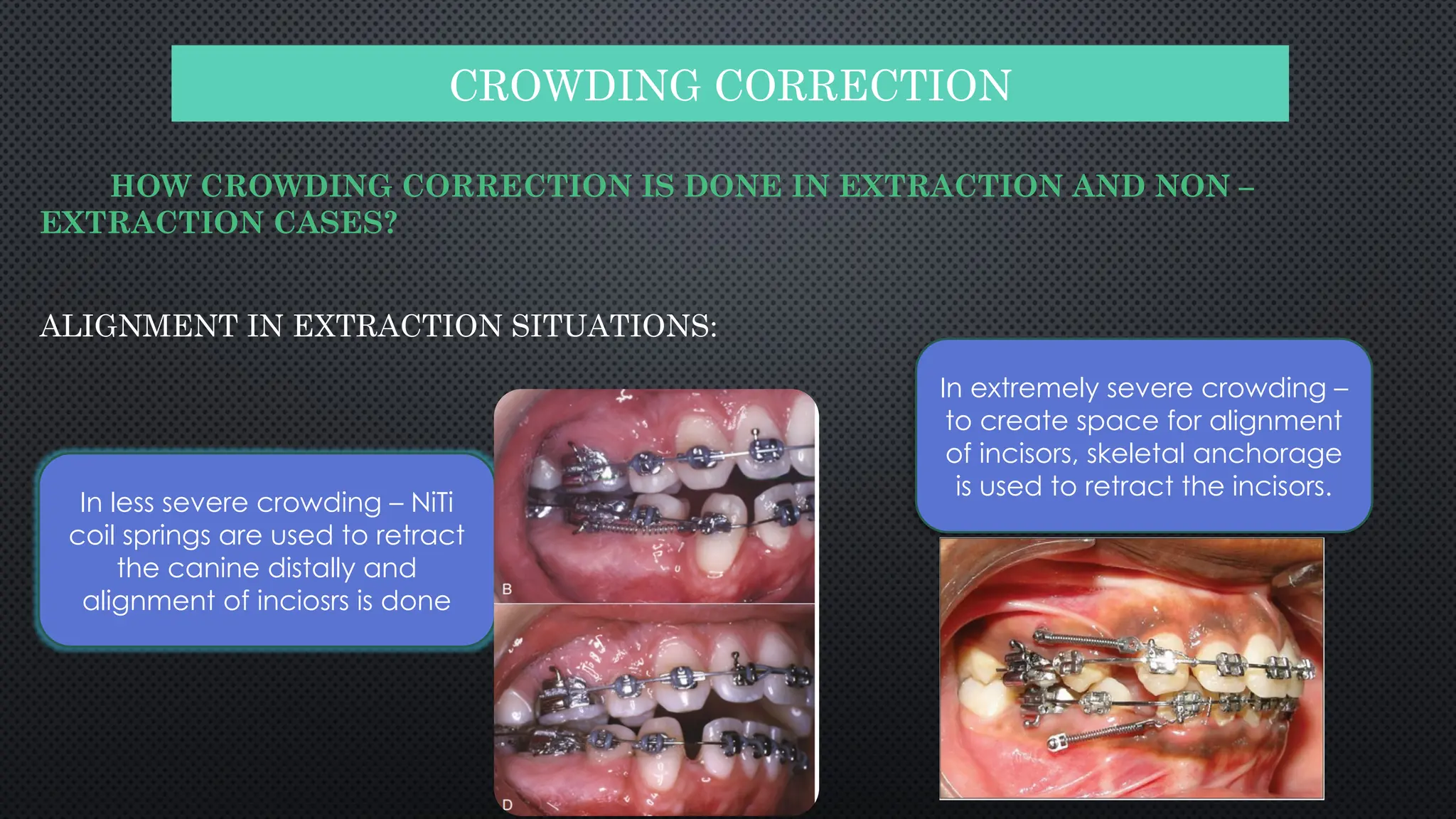 ALIGNMENT AND LEVELING powerpoint presentation .pptx