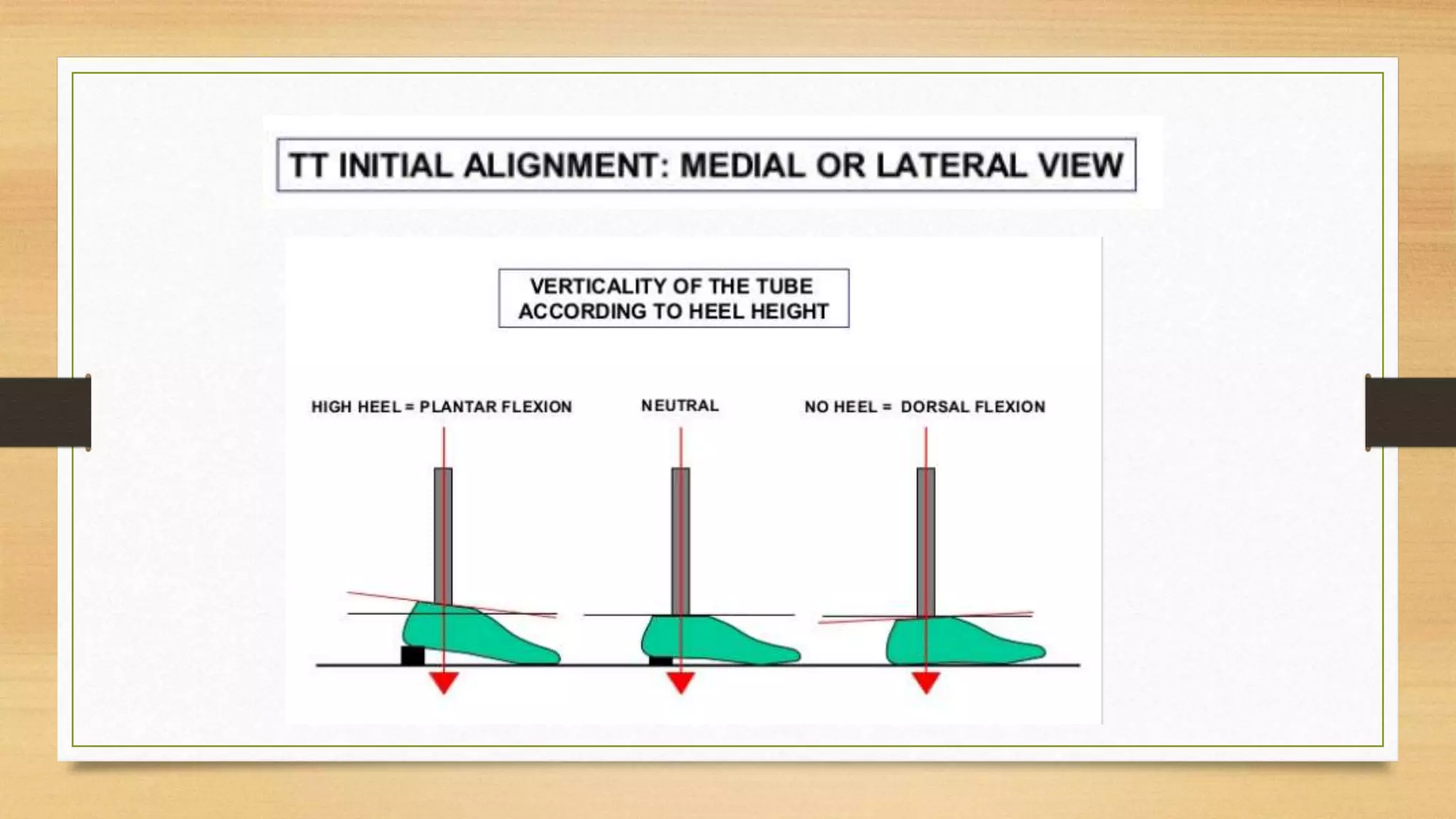 Alignment of Trans Tibial Prosthesis | PPTX