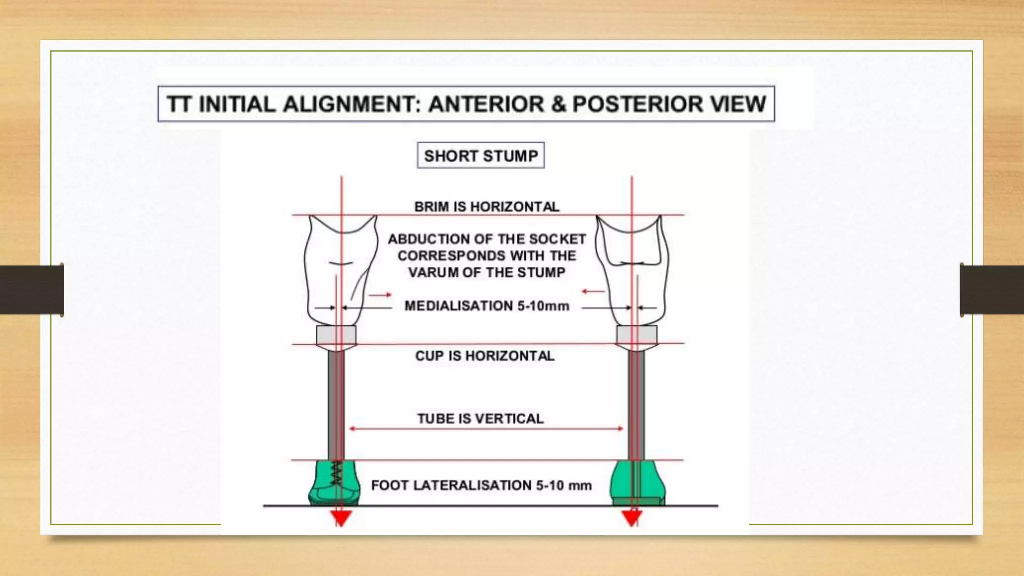 Alignment of Trans Tibial Prosthesis | PPTX