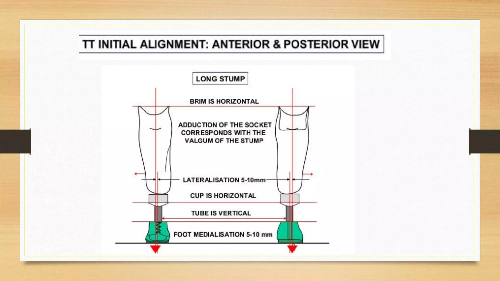 Alignment of Trans Tibial Prosthesis | PPTX