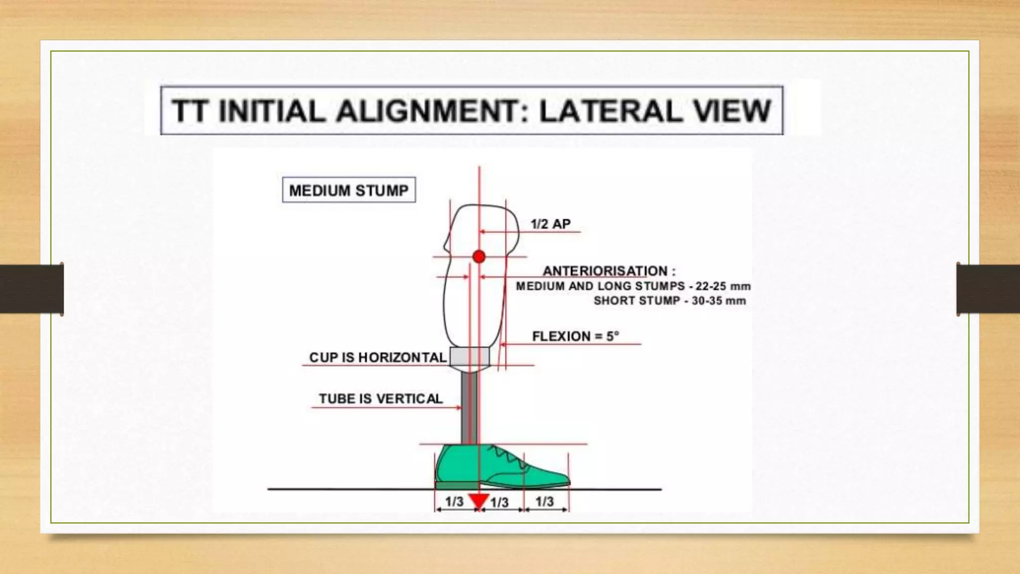 Alignment of Trans Tibial Prosthesis | PPTX