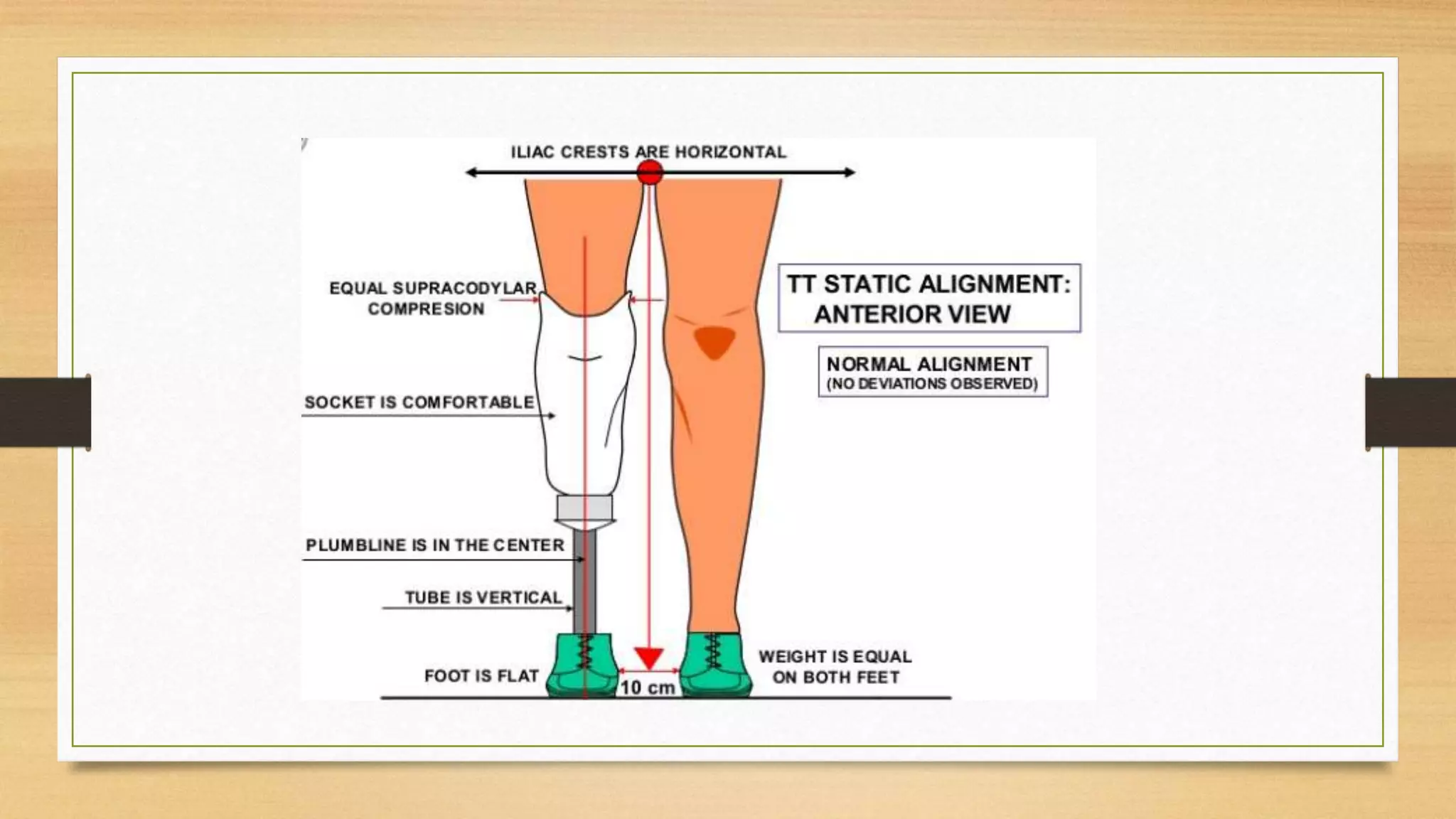 Alignment of Trans Tibial Prosthesis | PPTX