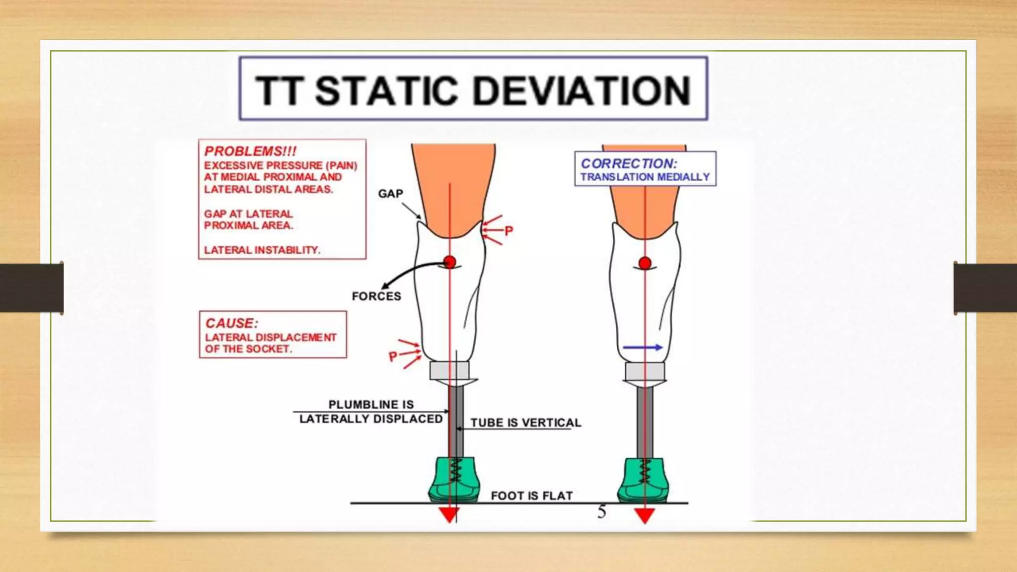 Alignment of Trans Tibial Prosthesis | PPTX