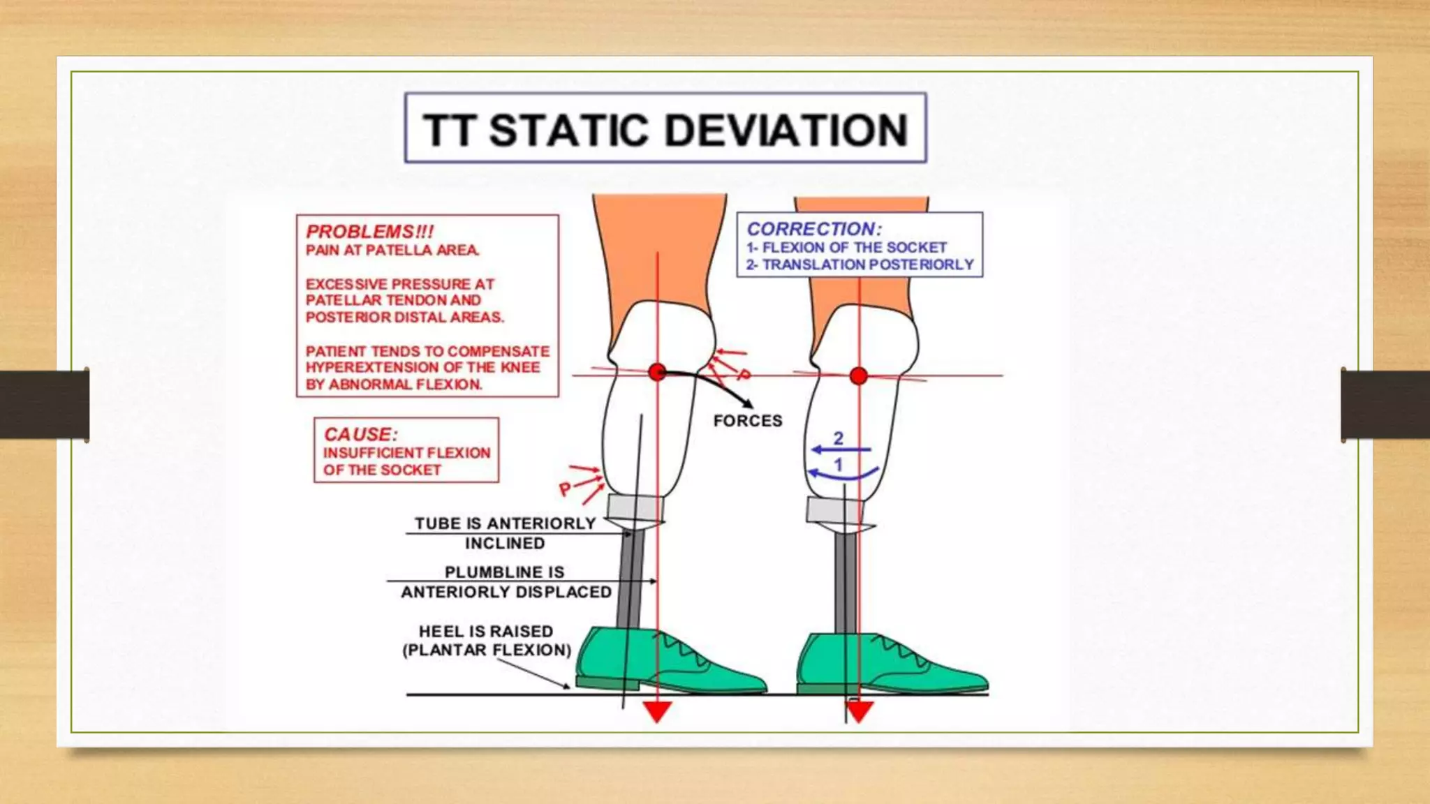 Alignment of Trans Tibial Prosthesis | PPTX