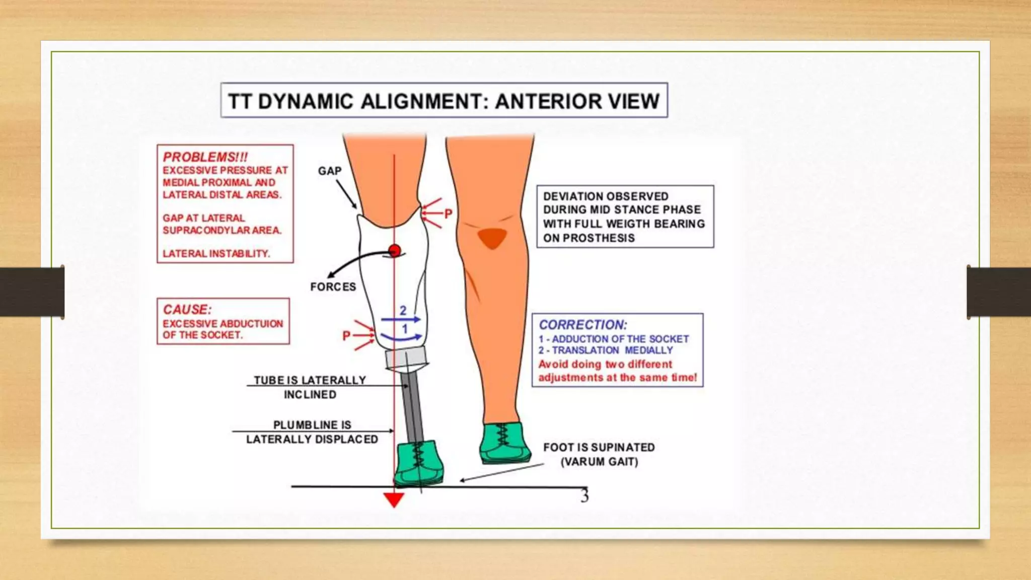 Alignment of Trans Tibial Prosthesis | PPTX