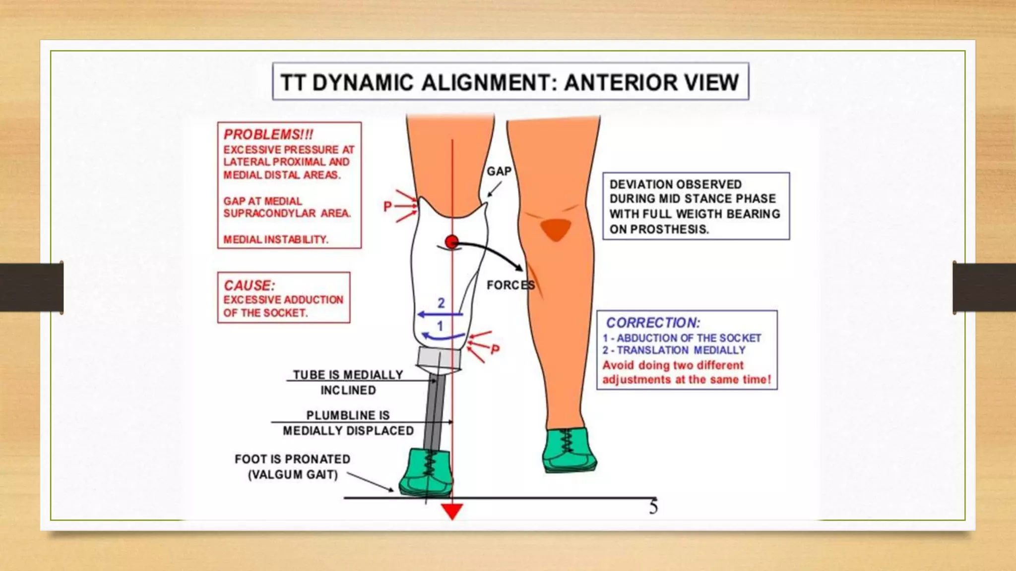 Alignment of Trans Tibial Prosthesis | PPTX