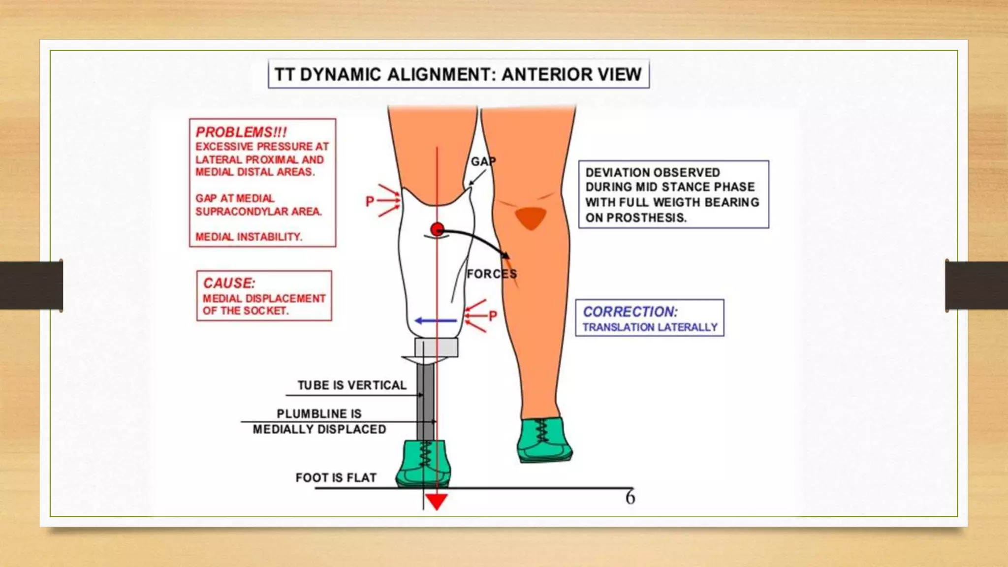Alignment of Trans Tibial Prosthesis | PPTX