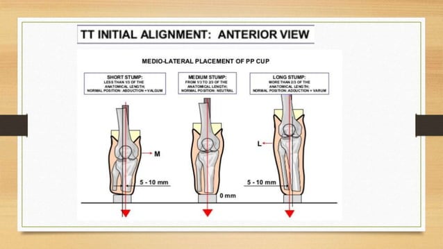 Alignment of Trans Tibial Prosthesis | PPTX