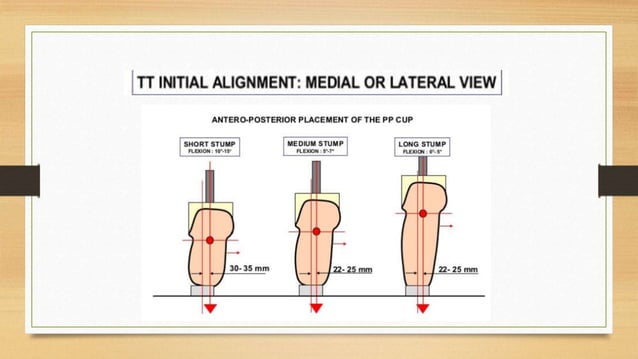 Alignment of Trans Tibial Prosthesis | PPTX