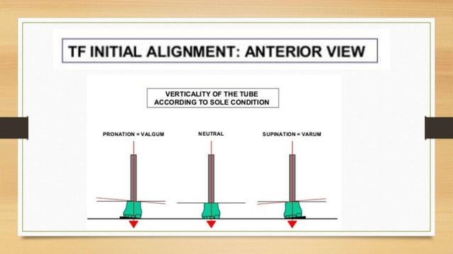 Alignment of Trans Tibial Prosthesis | PPTX