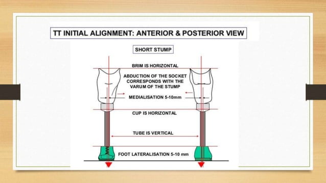 Alignment of Trans Tibial Prosthesis | PPTX