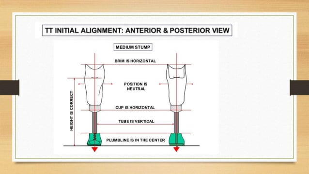 Alignment of Trans Tibial Prosthesis | PPTX