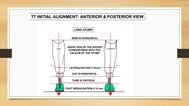 Alignment of Trans Tibial Prosthesis | PPTX