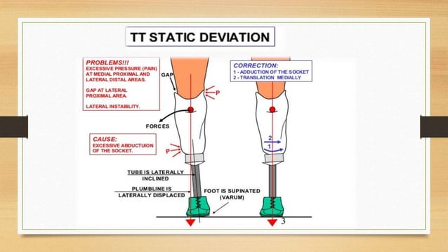 Alignment of Trans Tibial Prosthesis | PPTX