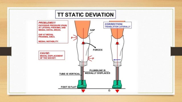 Alignment of Trans Tibial Prosthesis | PPTX